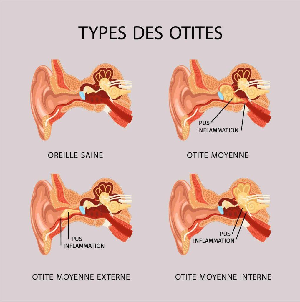 Otite : symptômes, traitements et prévention pour protéger votre audition