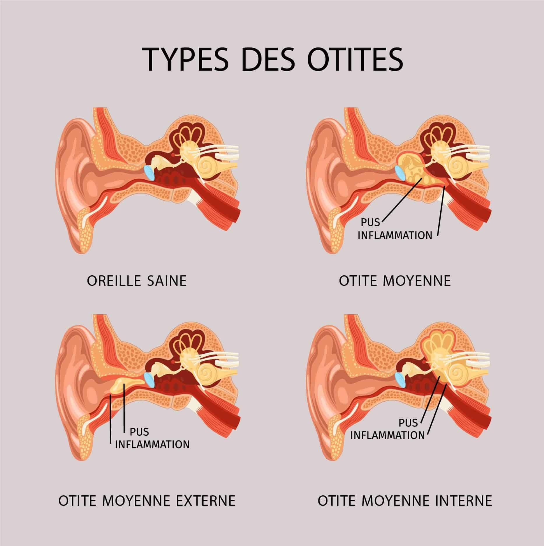 Otite : causes, symptômes, traitements et conseils pour protéger votre audition