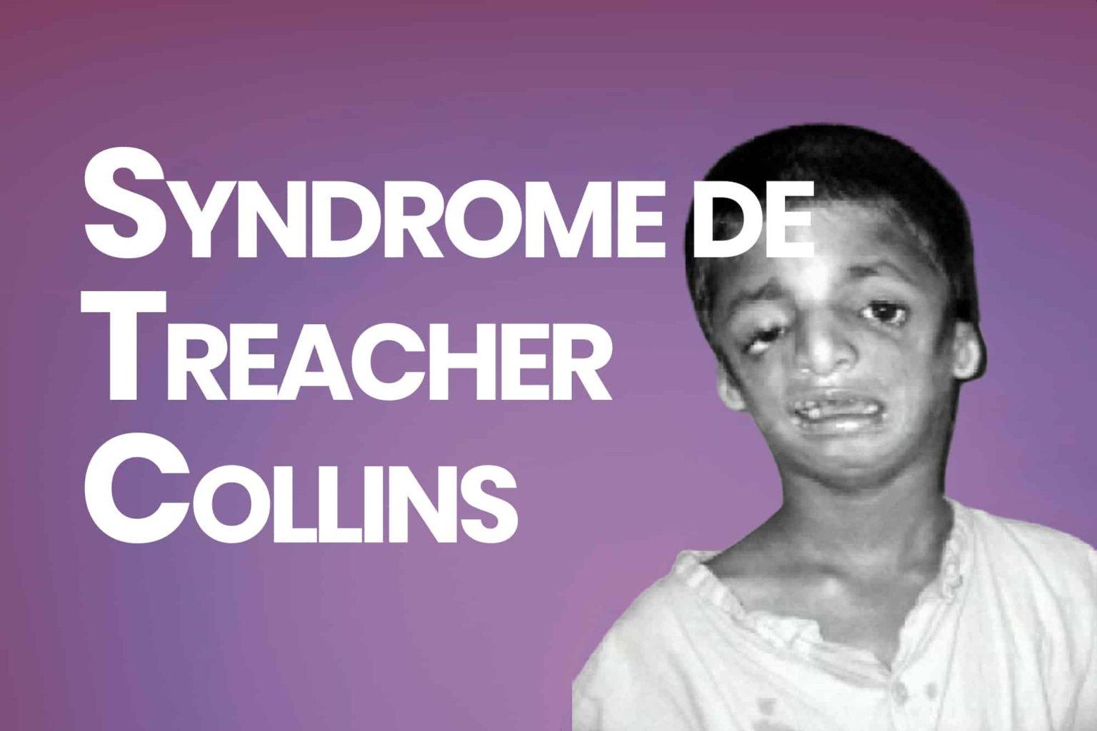 Syndrome de Treacher Collins : Comprendre cette rare maladie génétique